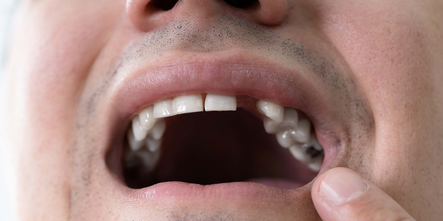 Replacing teeth lost through gum disease | Morris Dental Solutions